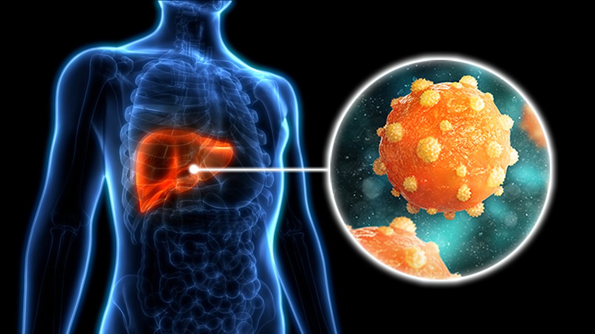 Hepatitis: Saat Hati Mengalami Peradangan dan Kehilangan Fungsinya ...